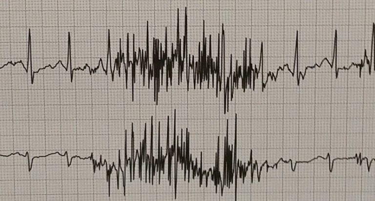 Electrodes And Skin Prep – The Student Physiologist