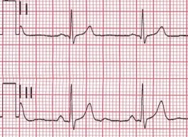 The Lewis Lead – The Student Physiologist