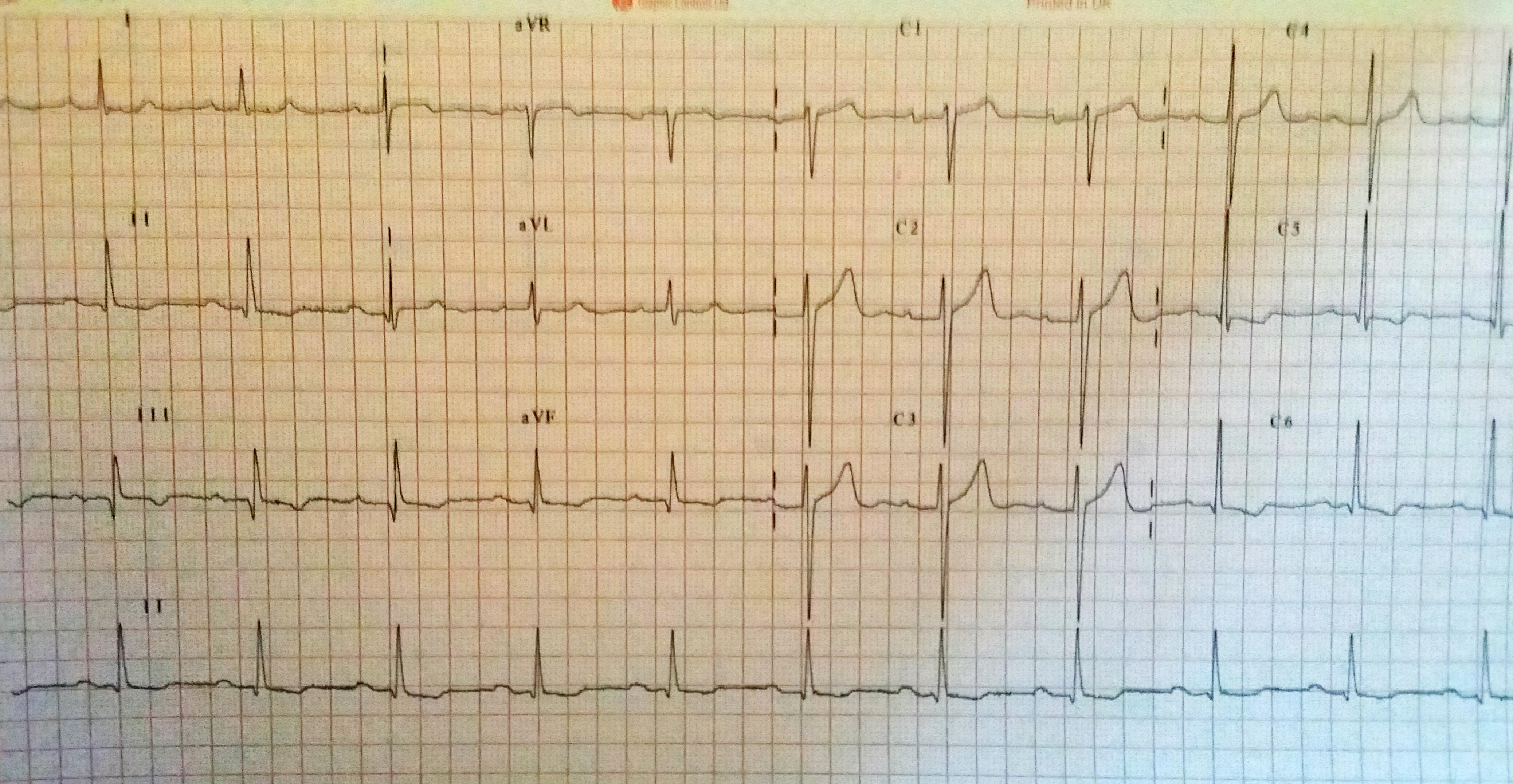 Determining Cardiac Axis – The Student Physiologist