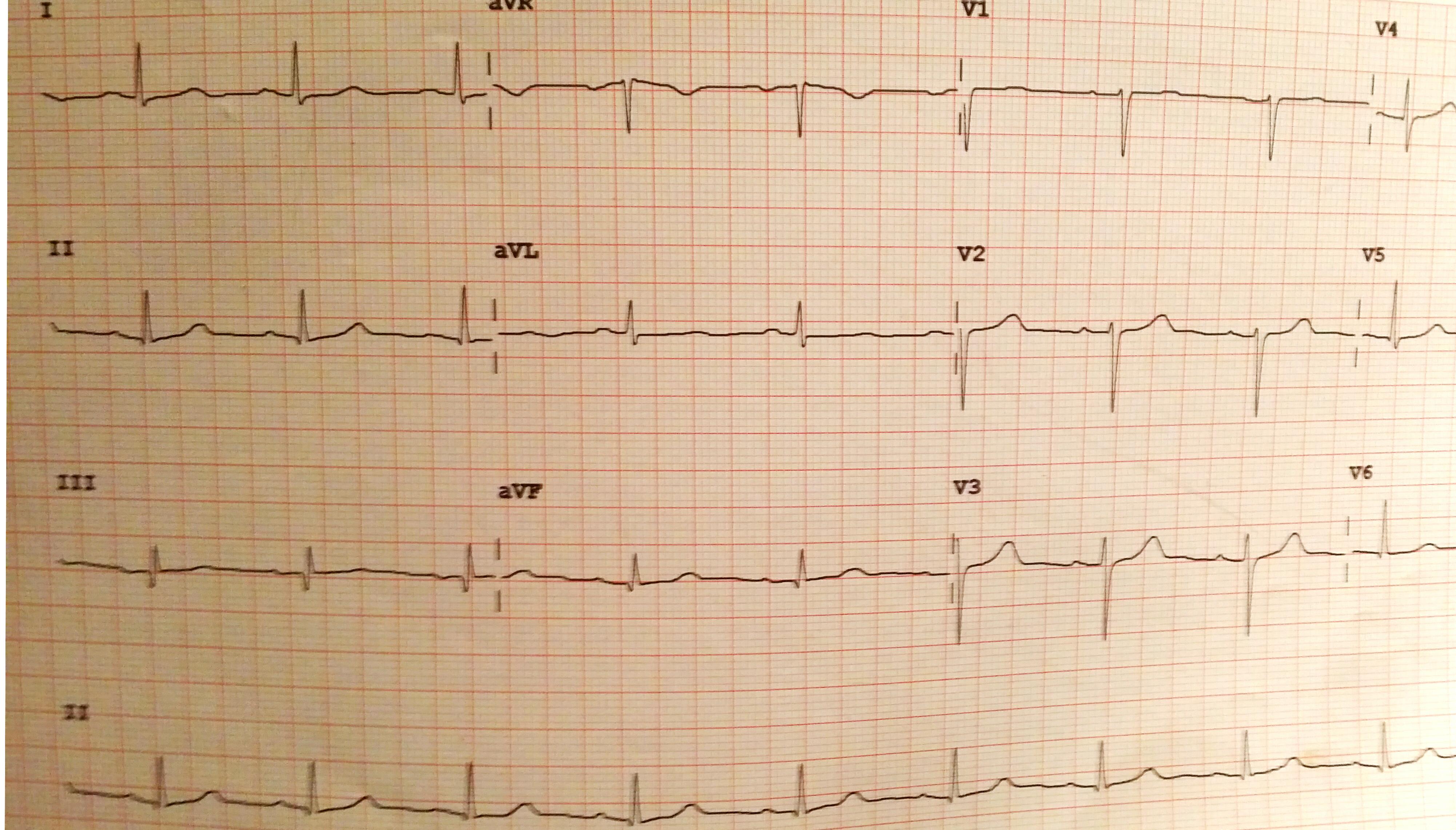Determining Cardiac Axis – The Student Physiologist