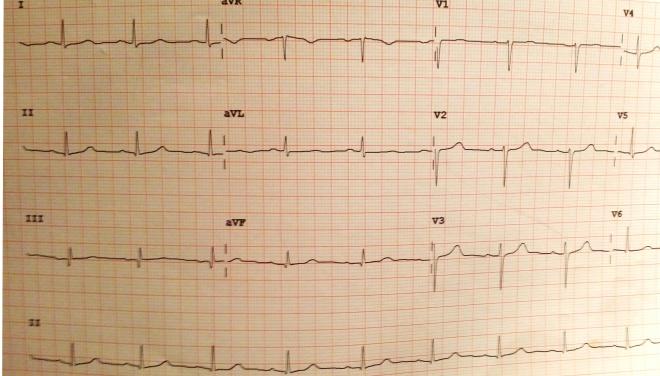 Determining Cardiac Axis – The Student Physiologist