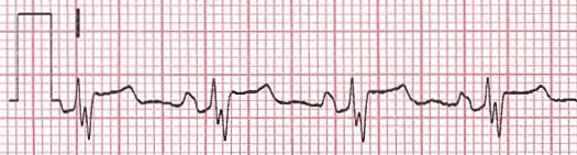 The Lewis Lead – The Student Physiologist