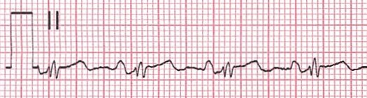 The Lewis Lead – The Student Physiologist