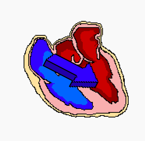 Determining Cardiac Axis – The Student Physiologist