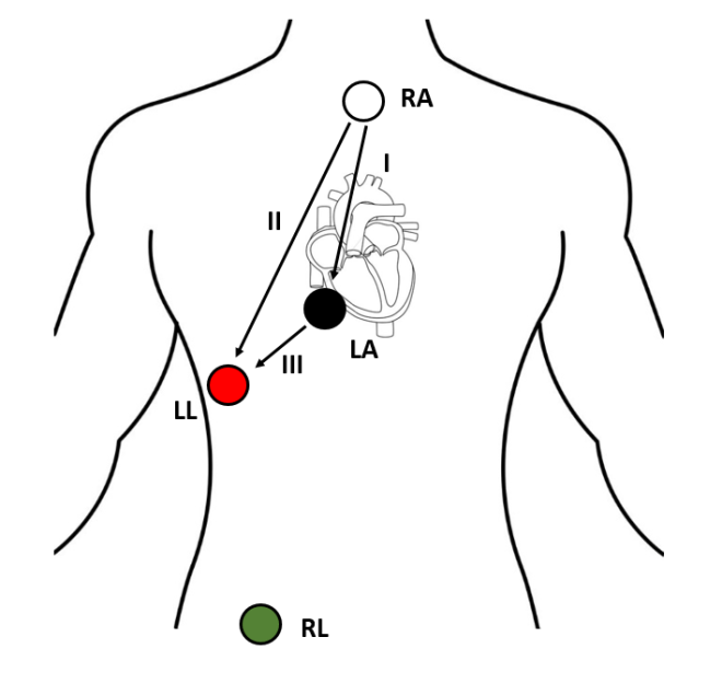 The Lewis Lead – The Student Physiologist