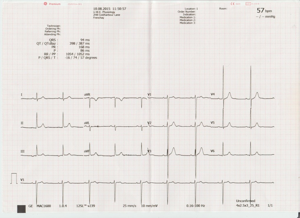 I Have LVH, Should I Be Worried? Normal Variants Of An ECG – The ...