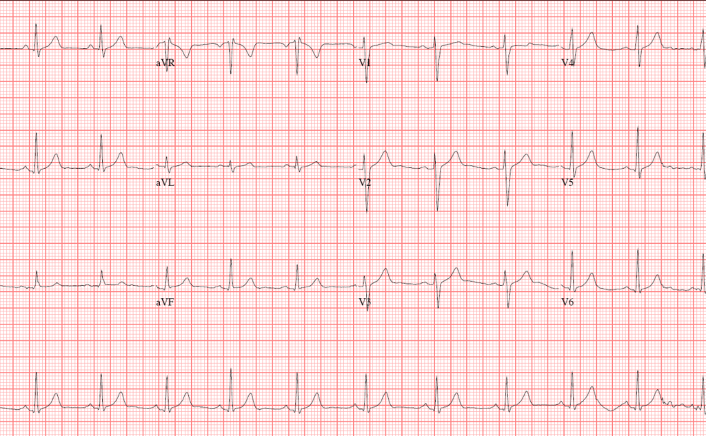 The Normal ECG – The Student Physiologist