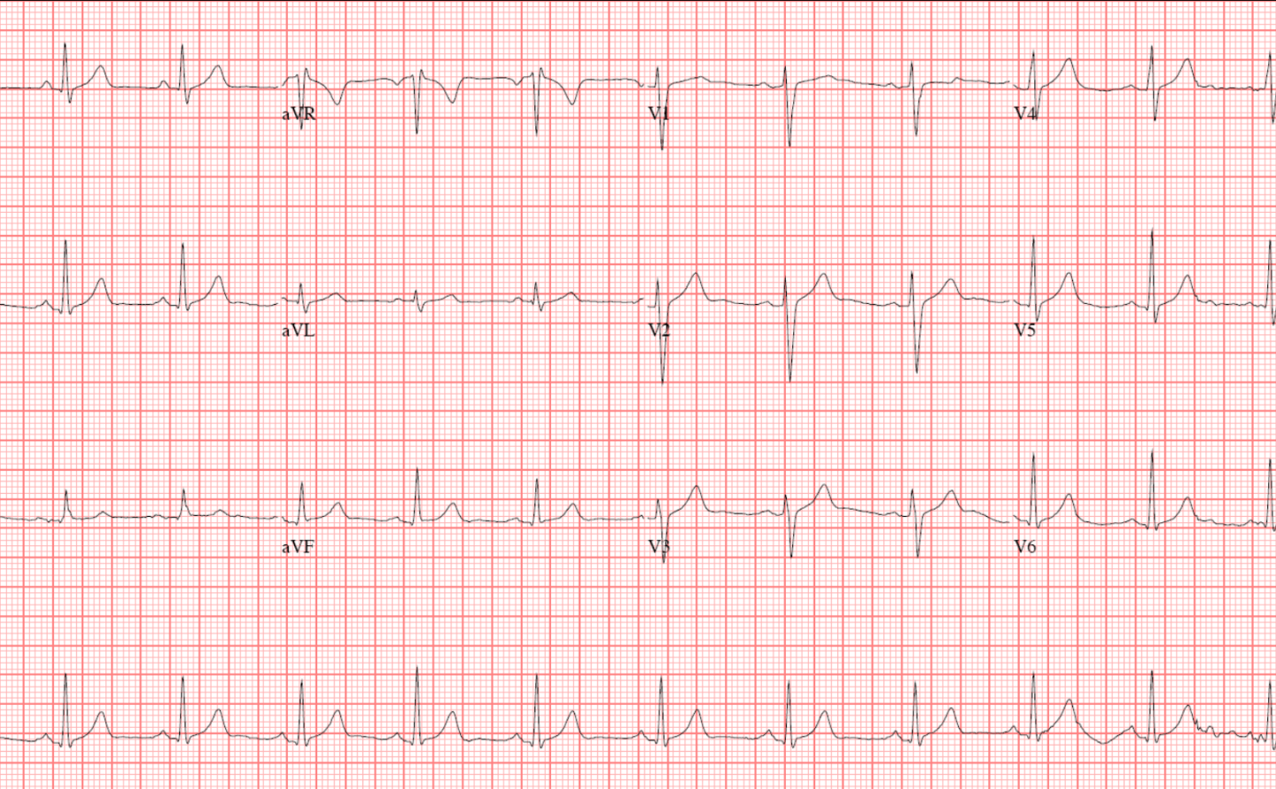 The Normal ECG – The Student Physiologist