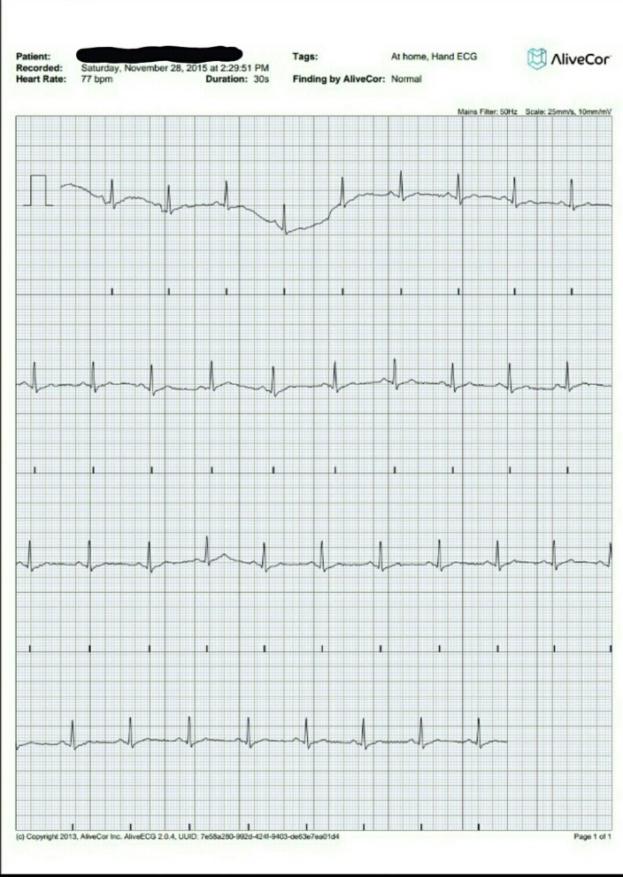 Review: AliveCor Mobile ECG Monitor (3rd gen) – The Student Physiologist