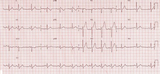 The Sinus Rhythms – The Student Physiologist