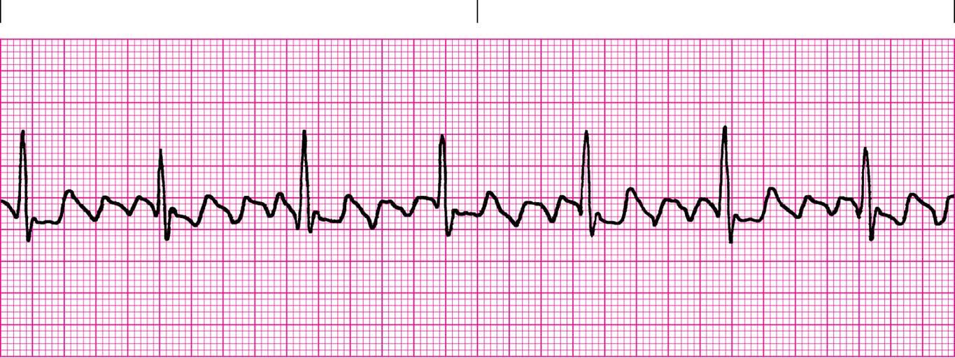 Atrial Flutter – The Student Physiologist