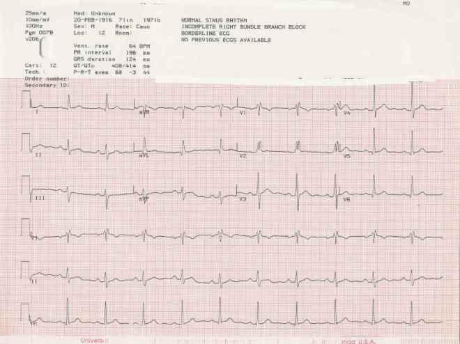 Bundle Branch Blocks – The Student Physiologist