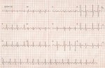 Atrial Flutter – The Student Physiologist