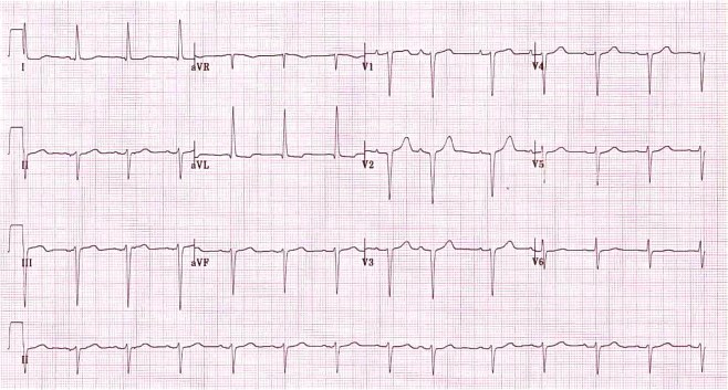 Bundle Branch Blocks – The Student Physiologist