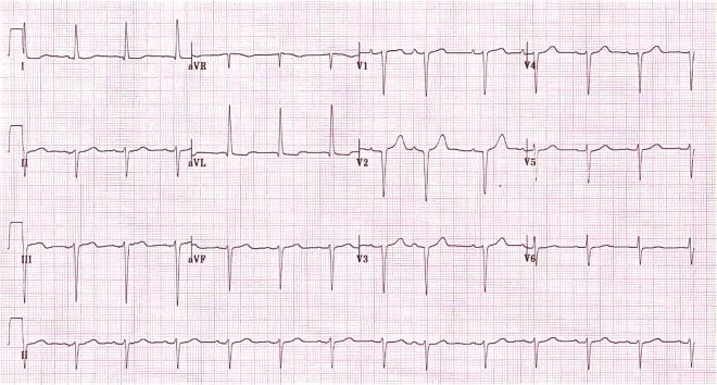 Bundle Branch Blocks – The Student Physiologist