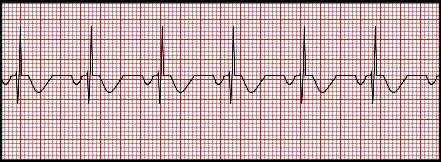 ECG Artifact – The Student Physiologist