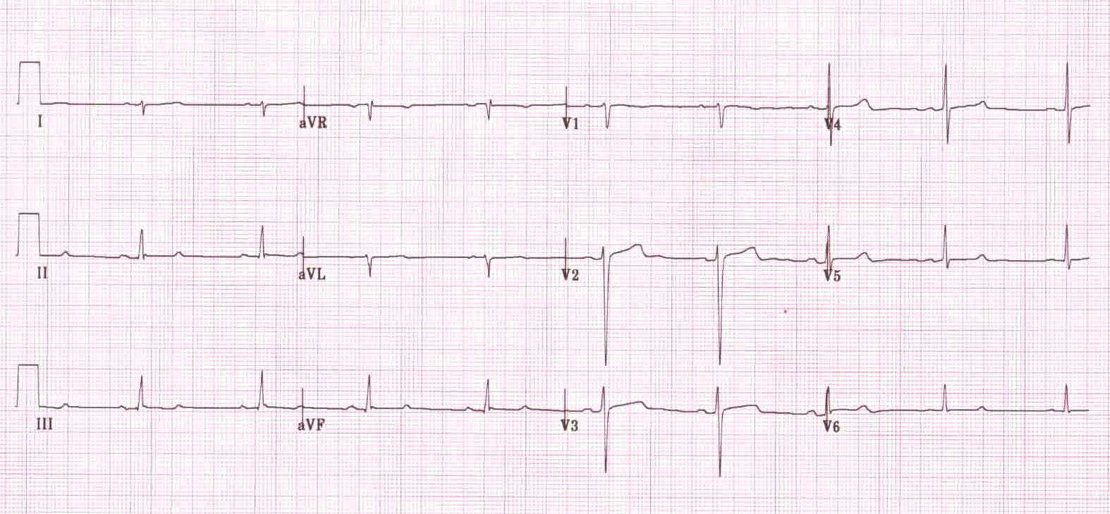 Bundle Branch Blocks – The Student Physiologist