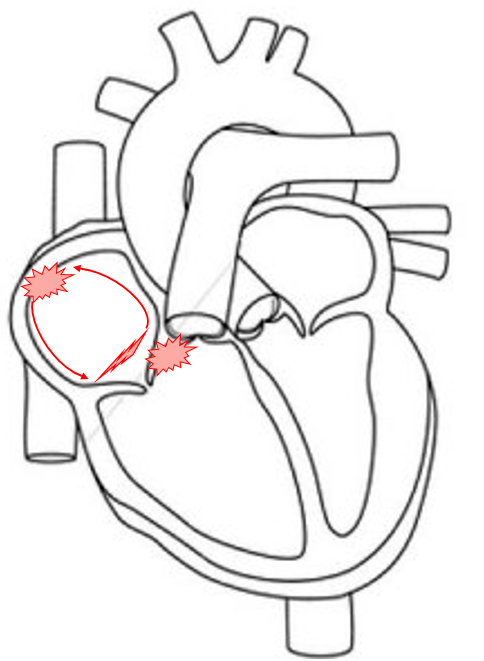 Atrial Flutter – The Student Physiologist