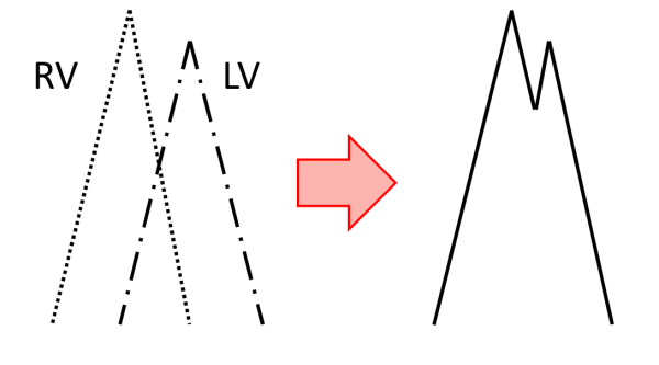 Bundle Branch Blocks – The Student Physiologist