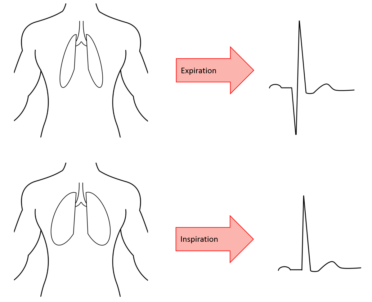 Q Waves – The Student Physiologist