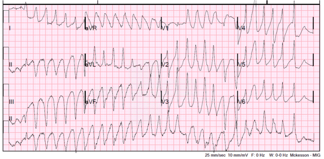 Ventricular Tachycardia – The Student Physiologist