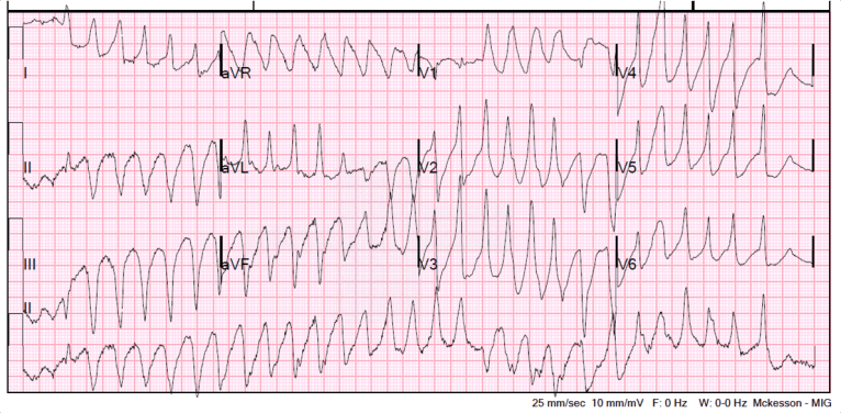 Ventricular Tachycardia – The Student Physiologist