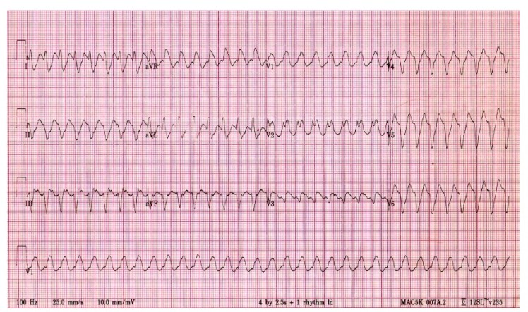 Ventricular Tachycardia – The Student Physiologist