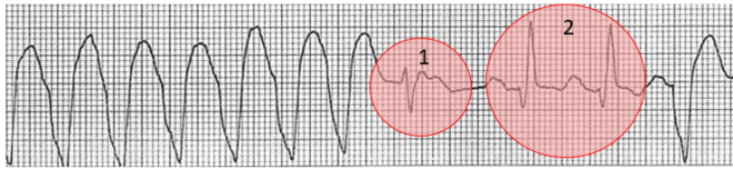 Ventricular Tachycardia – The Student Physiologist