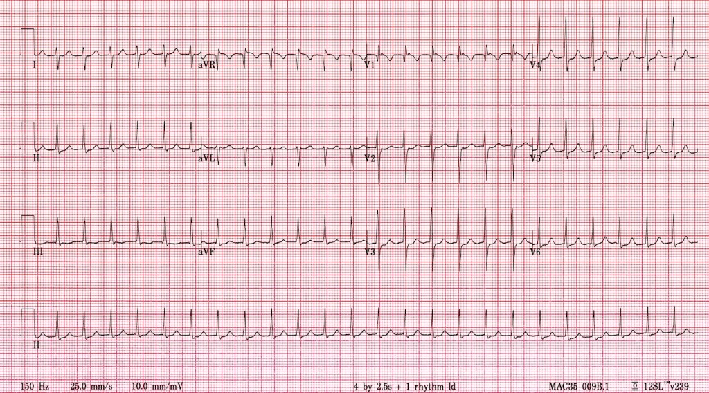 AVNRT and AVRT – The Student Physiologist