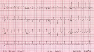 AVNRT and AVRT – The Student Physiologist