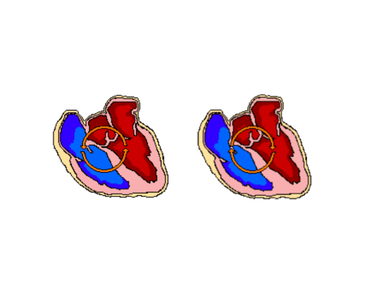 AVNRT and AVRT – The Student Physiologist