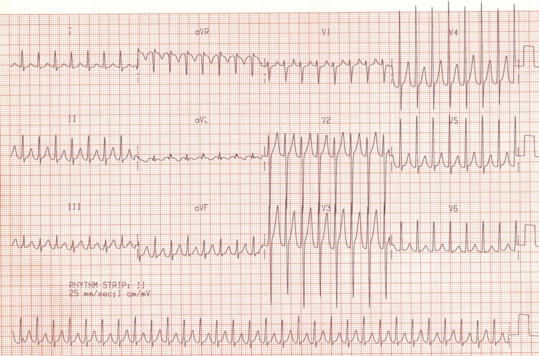 AVNRT and AVRT – The Student Physiologist