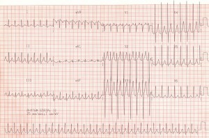 AVNRT and AVRT – The Student Physiologist