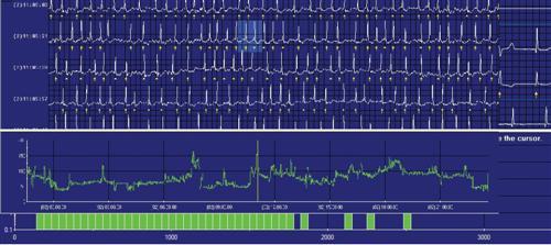 Week 3: The Learning Curve of Holter Analysis – The Student Physiologist