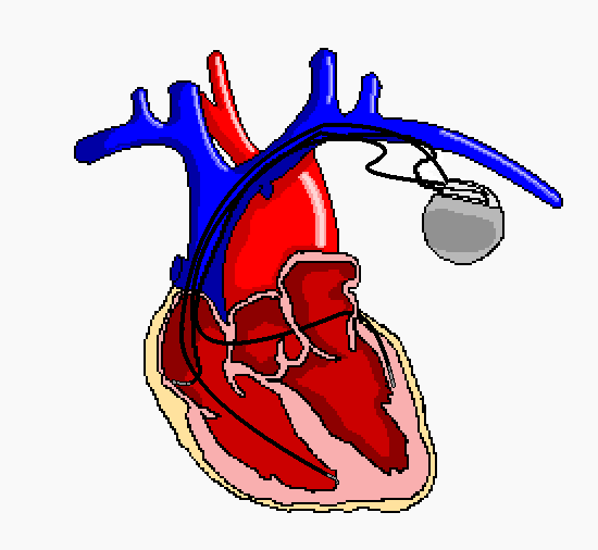 Basic Pacing Modes – The Student Physiologist