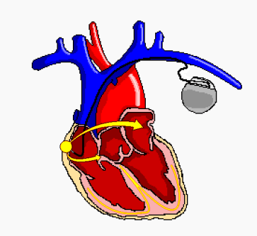 Basic Pacing Modes – The Student Physiologist