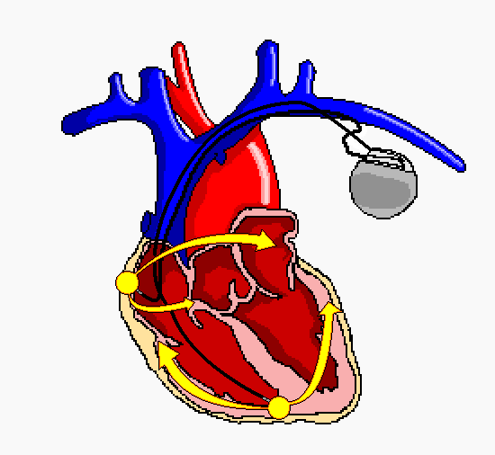 Basic Pacing Modes – The Student Physiologist