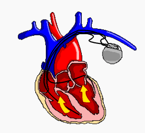 Basic Pacing Modes – The Student Physiologist