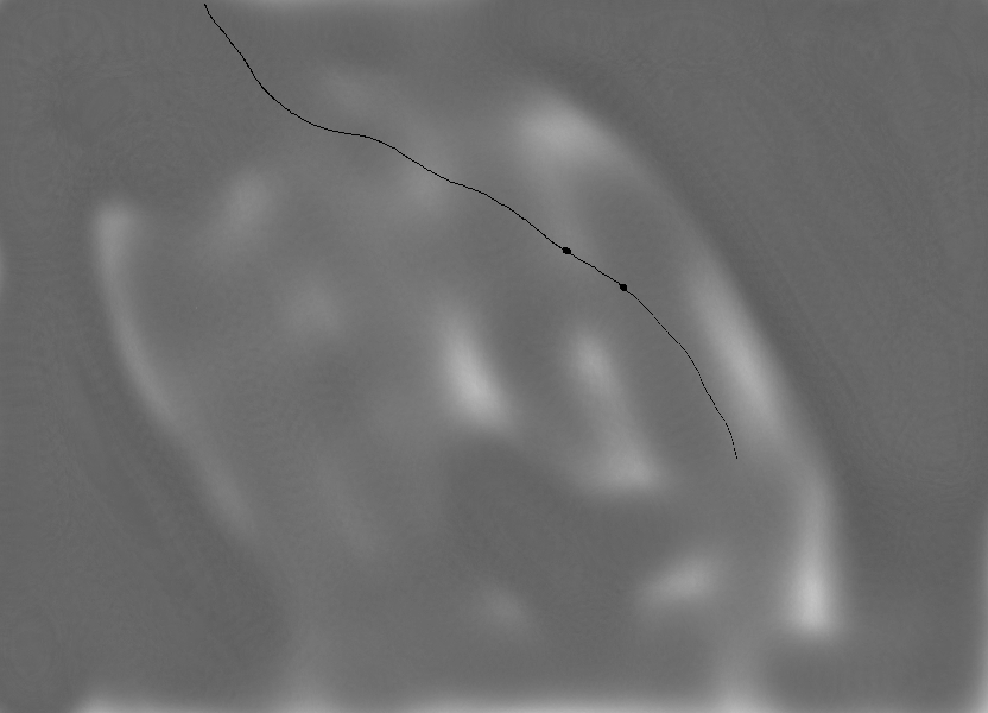 Balloon Positioning – The Student Physiologist